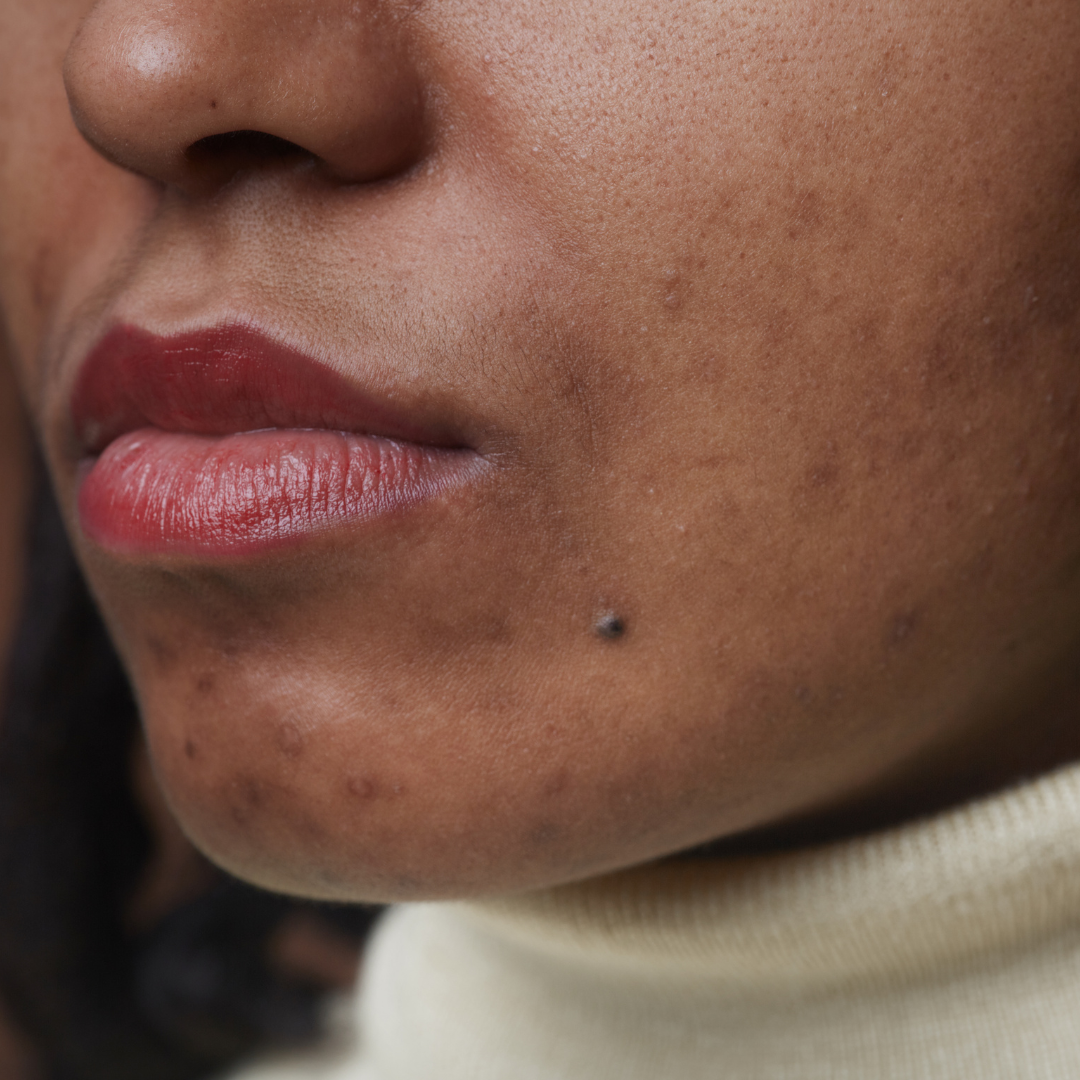 The best step-by-step skincare routine to treat your acne and breakouts ...